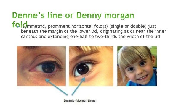 Signs in dermatology.pptx