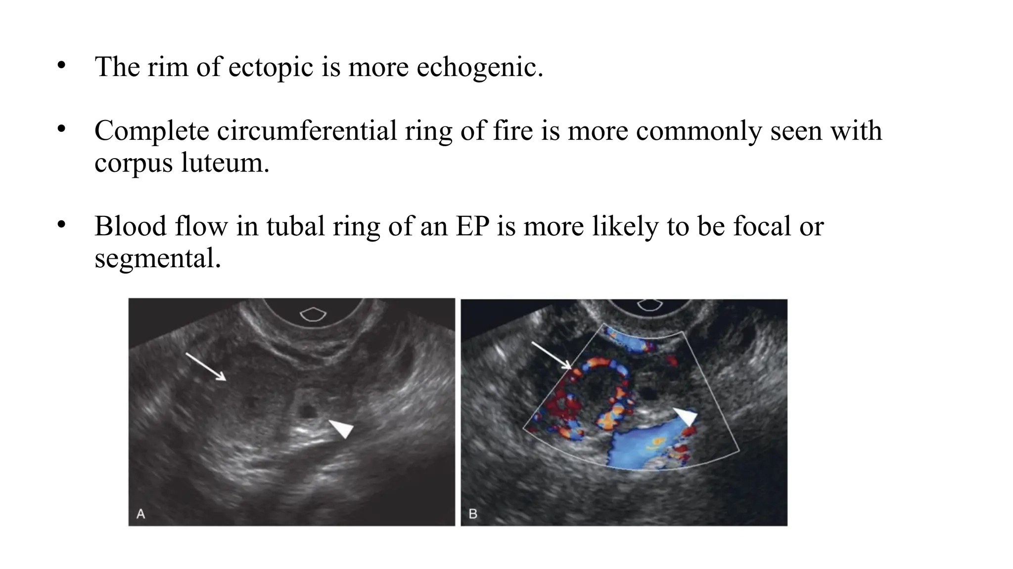 SIGNS IN ECTOPIC PREGNANCY USG- TVS AND TAS .pptx