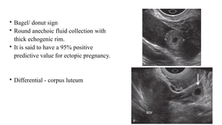 SIGNS IN ECTOPIC PREGNANCY USG- TVS AND TAS .pptx