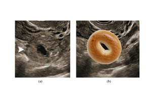 SIGNS IN ECTOPIC PREGNANCY USG- TVS AND TAS .pptx