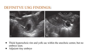 SIGNS IN ECTOPIC PREGNANCY USG- TVS AND TAS .pptx