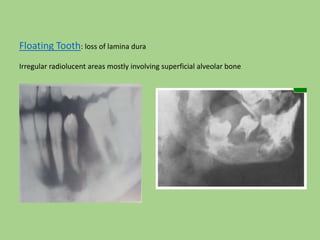 SIGNS IN EOSINOPHILIC GRANULOMA 23.03.24.pptx