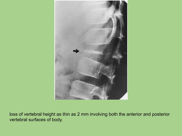 SIGNS IN EOSINOPHILIC GRANULOMA 23.03.24.pptx