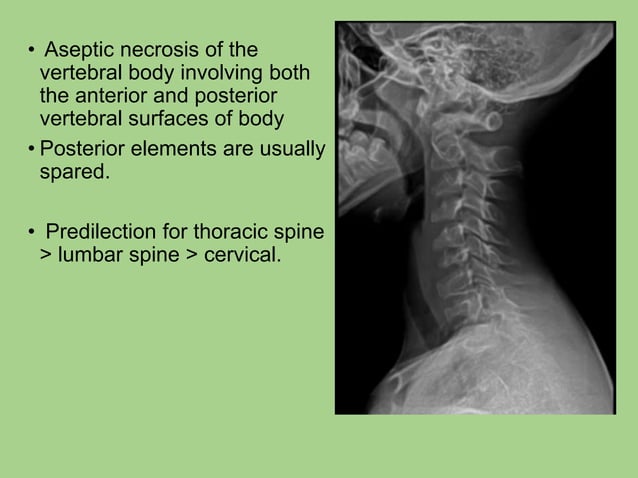 SIGNS IN EOSINOPHILIC GRANULOMA 23.03.24.pptx