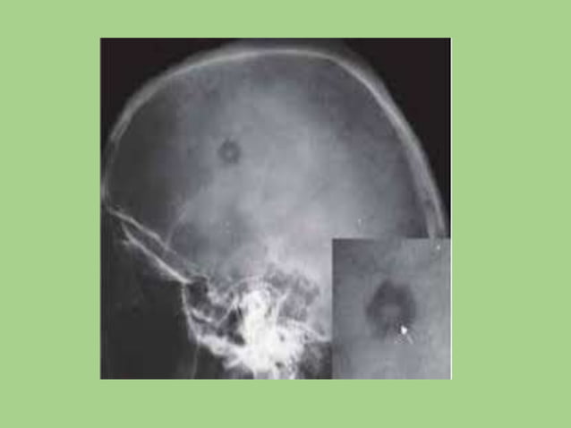 SIGNS IN EOSINOPHILIC GRANULOMA 23.03.24.pptx