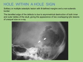 SIGNS IN EOSINOPHILIC GRANULOMA 23.03.24.pptx