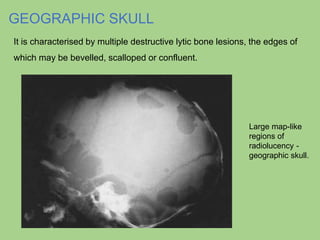 SIGNS IN EOSINOPHILIC GRANULOMA 23.03.24.pptx