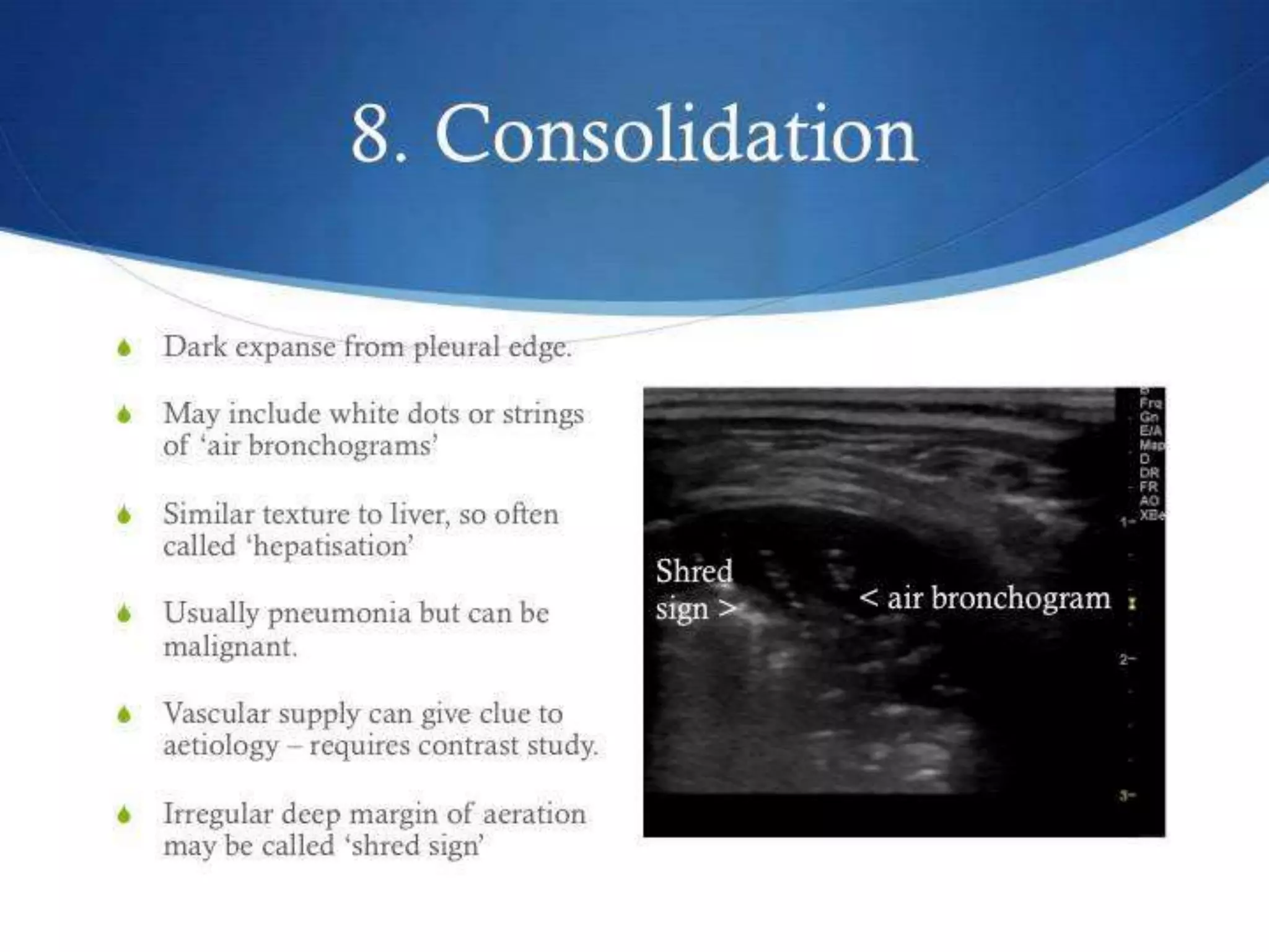 Signs in Lung Ultrasound | PPTX