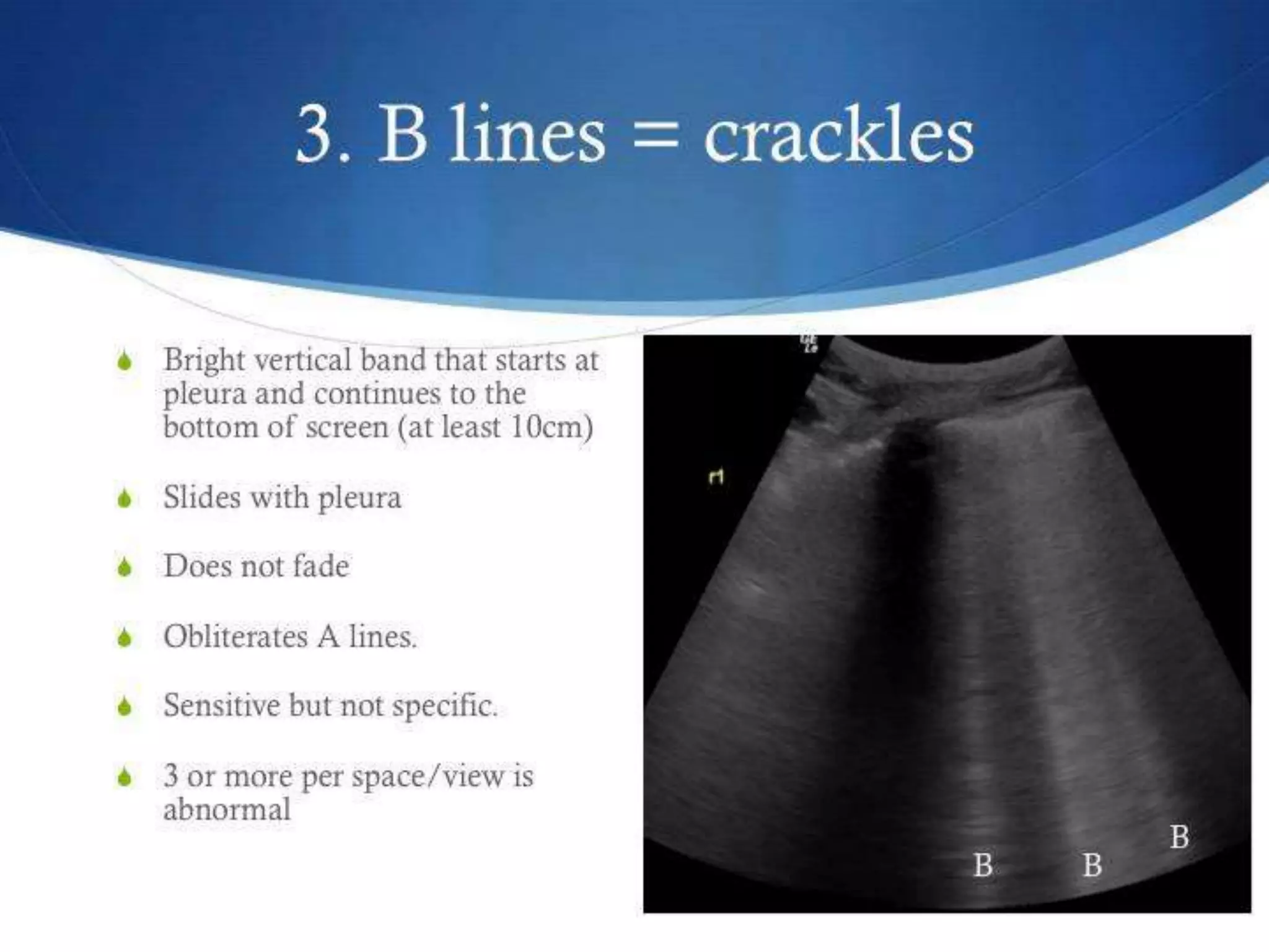 Signs in Lung Ultrasound | PPTX