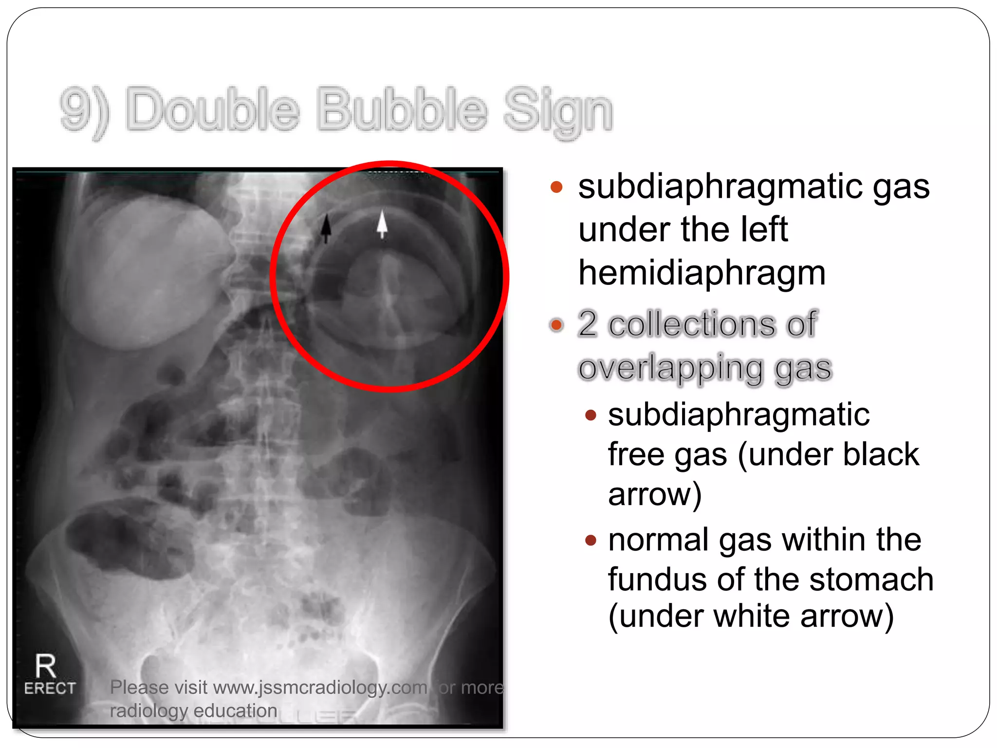 Signs in pneumoperitoneum | PPTX