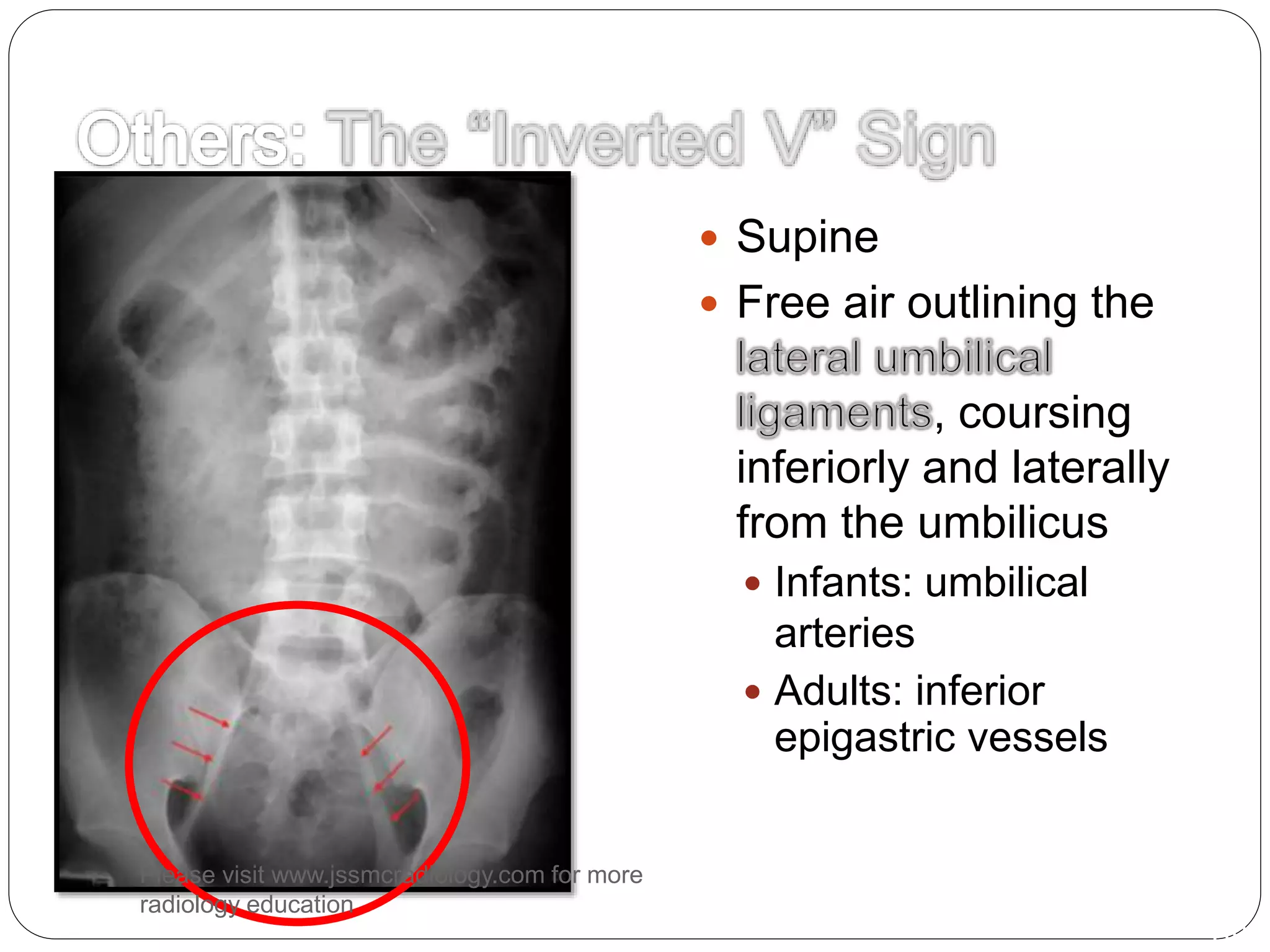 Signs in pneumoperitoneum | PPTX