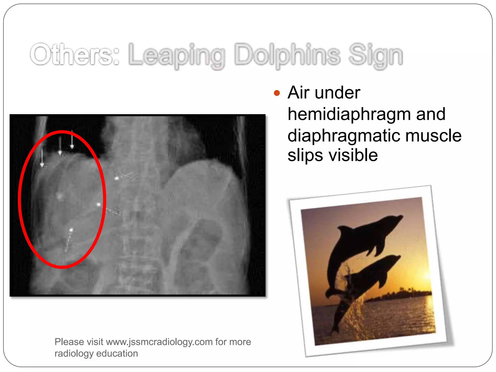Signs in pneumoperitoneum | PPTX