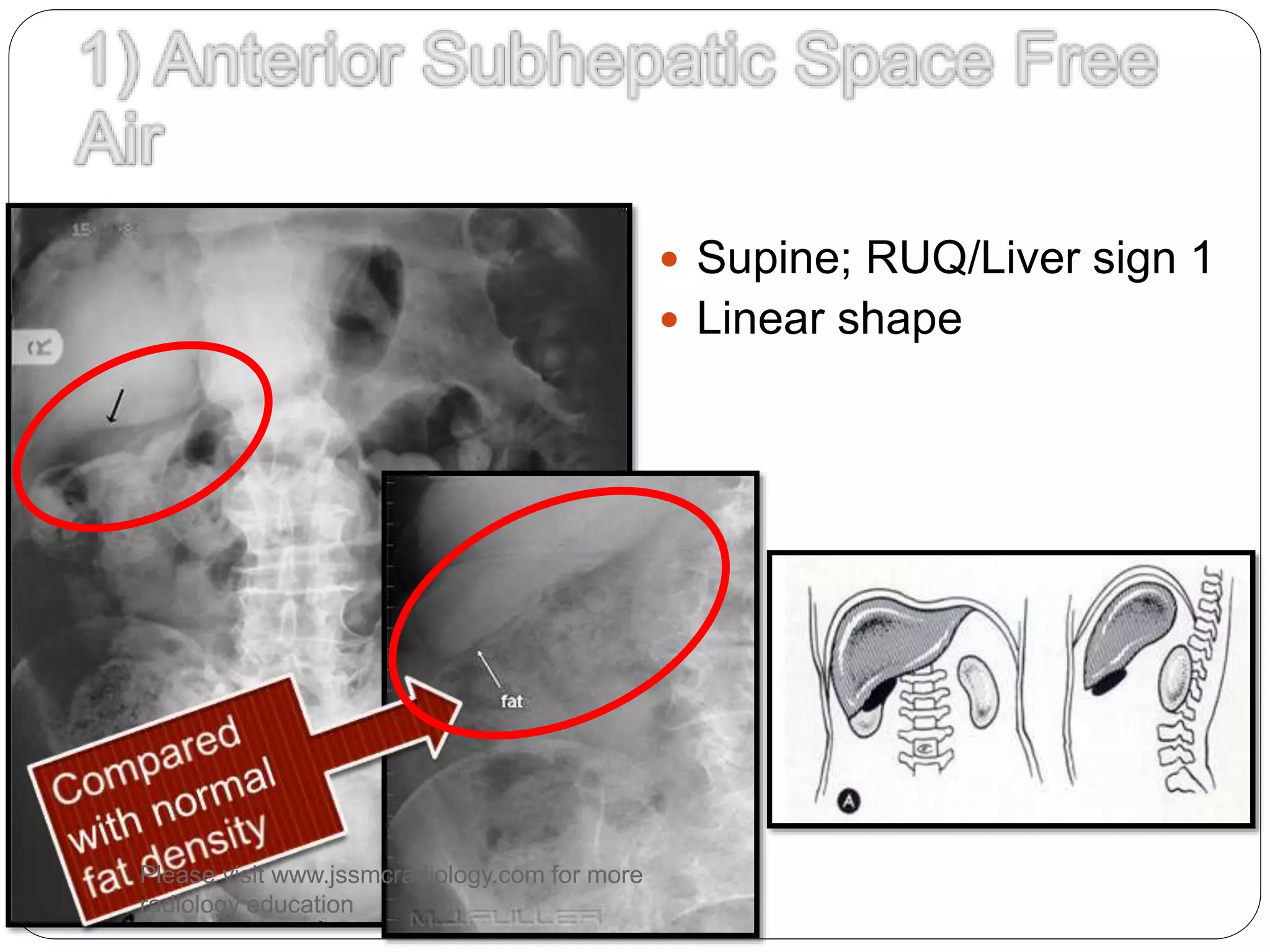 Signs in pneumoperitoneum | PPTX