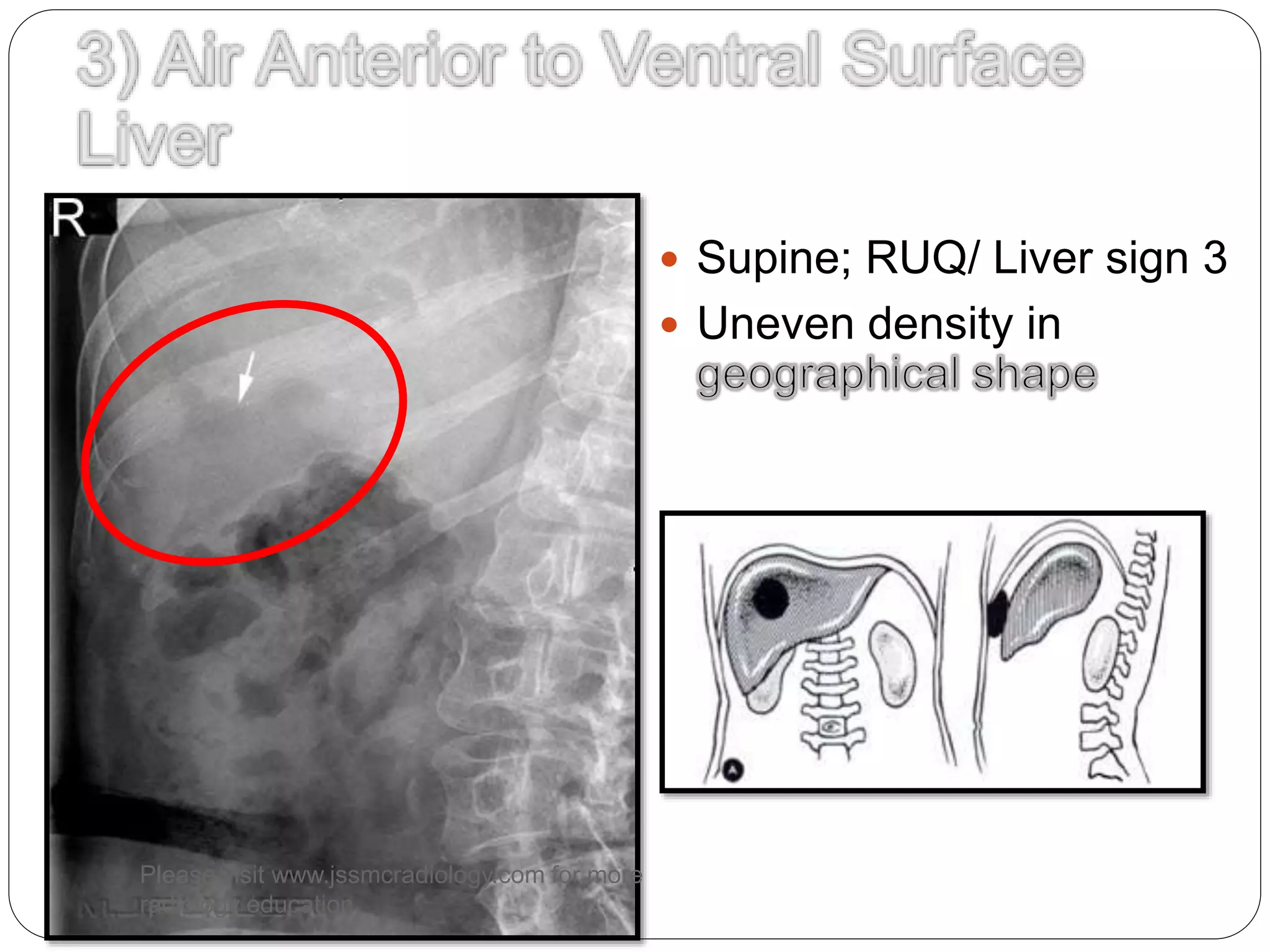 Signs in pneumoperitoneum | PPTX