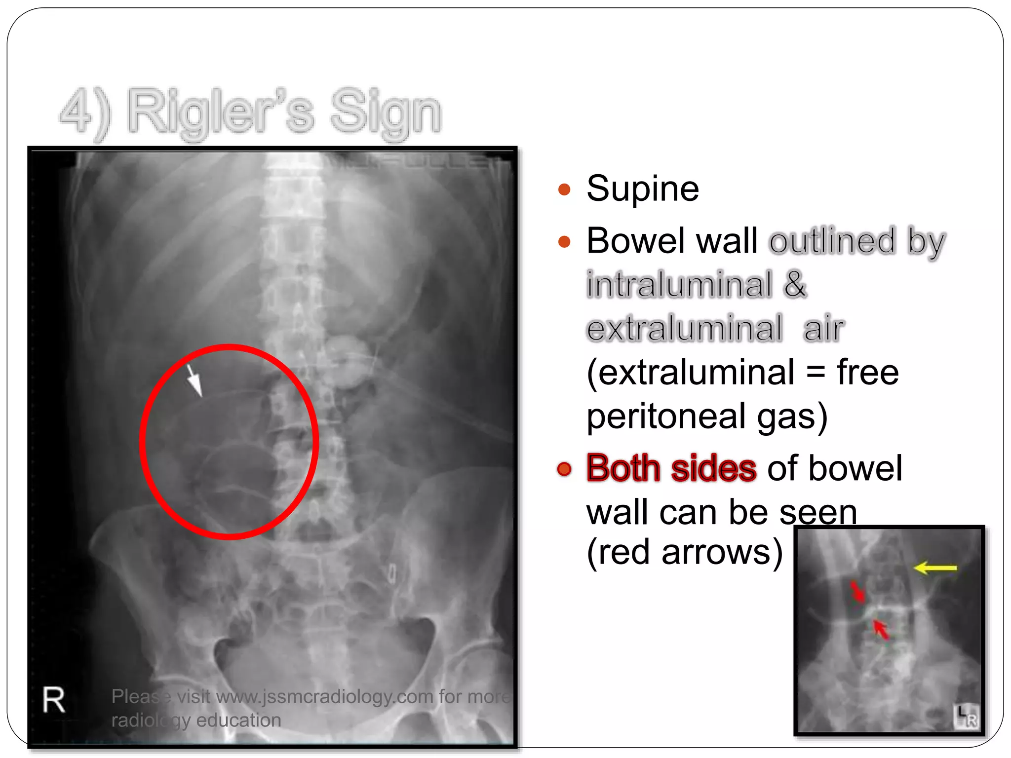 Signs in pneumoperitoneum | PPTX