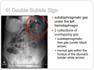 Signs in pneumoperitoneum | PPTX