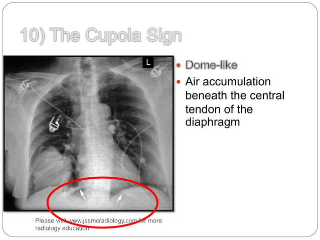 Signs in pneumoperitoneum | PPTX | Lung and Respiratory Health ...