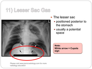 Signs in pneumoperitoneum | PPTX