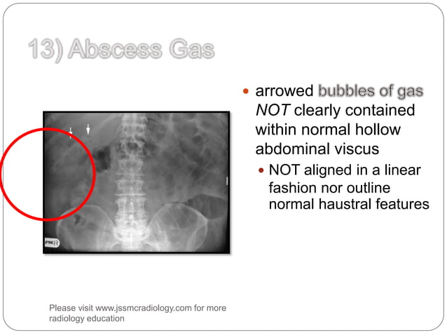 Signs in pneumoperitoneum | PPTX | Lung and Respiratory Health ...