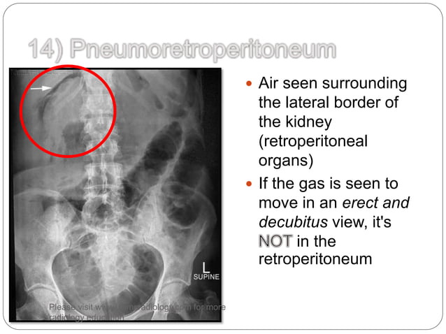 Signs in pneumoperitoneum | PPTX | Lung and Respiratory Health ...