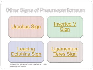 Signs in pneumoperitoneum | PPTX