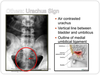 Signs in pneumoperitoneum | PPTX