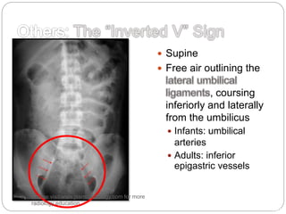 Signs in pneumoperitoneum | PPTX