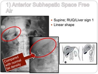 Signs in pneumoperitoneum | PPTX