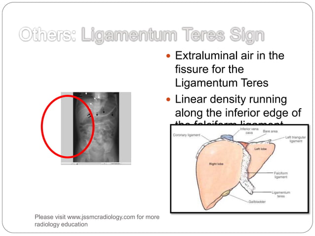 Signs in pneumoperitoneum | PPTX | Lung and Respiratory Health ...