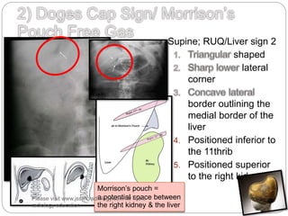 Signs in pneumoperitoneum | PPTX