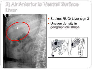 Signs in pneumoperitoneum | PPTX