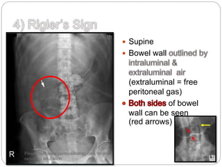 Signs in pneumoperitoneum | PPTX