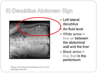 Signs in pneumoperitoneum | PPTX