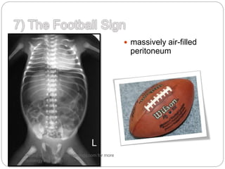 Signs in pneumoperitoneum | PPTX