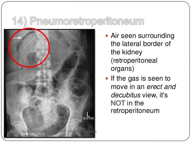 Signs in pneumoperitoneum