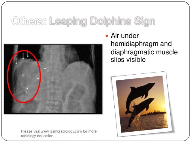 Signs in pneumoperitoneum