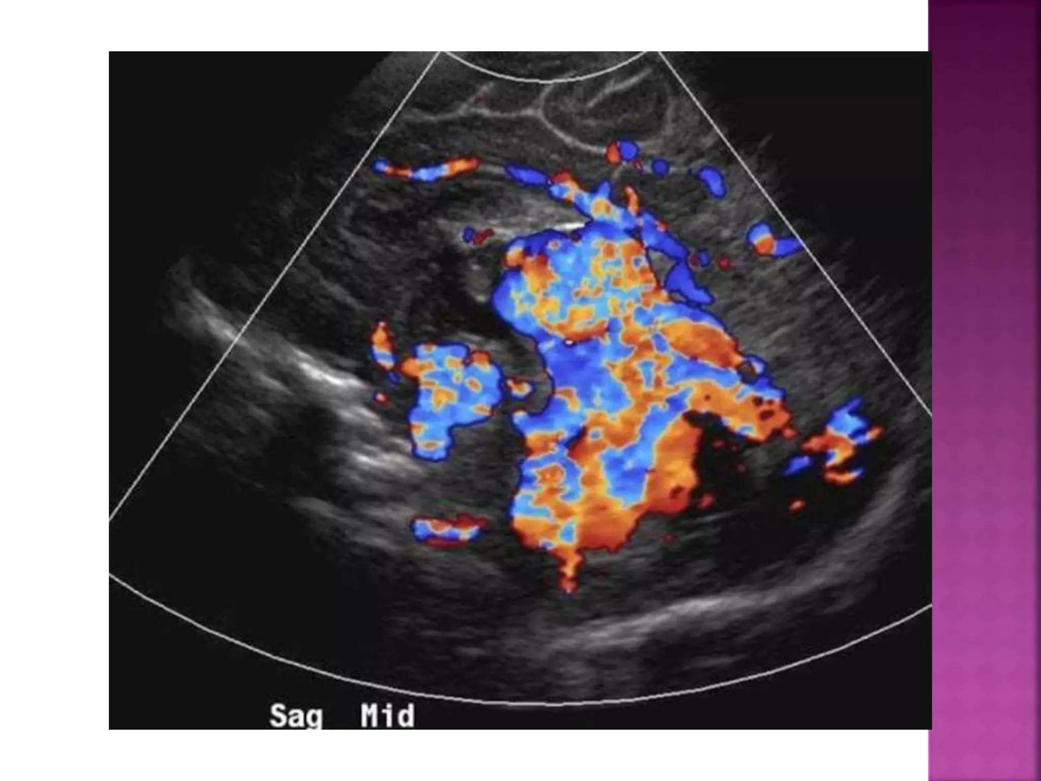 Signs in radiology | PPT
