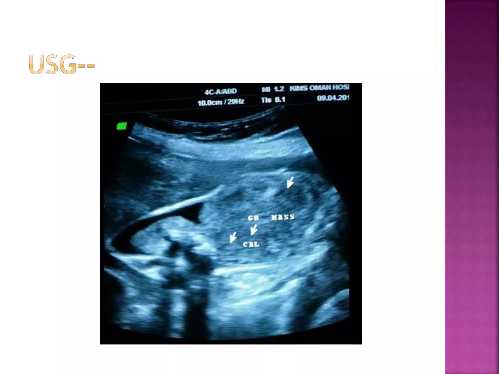 Signs in radiology | PPT