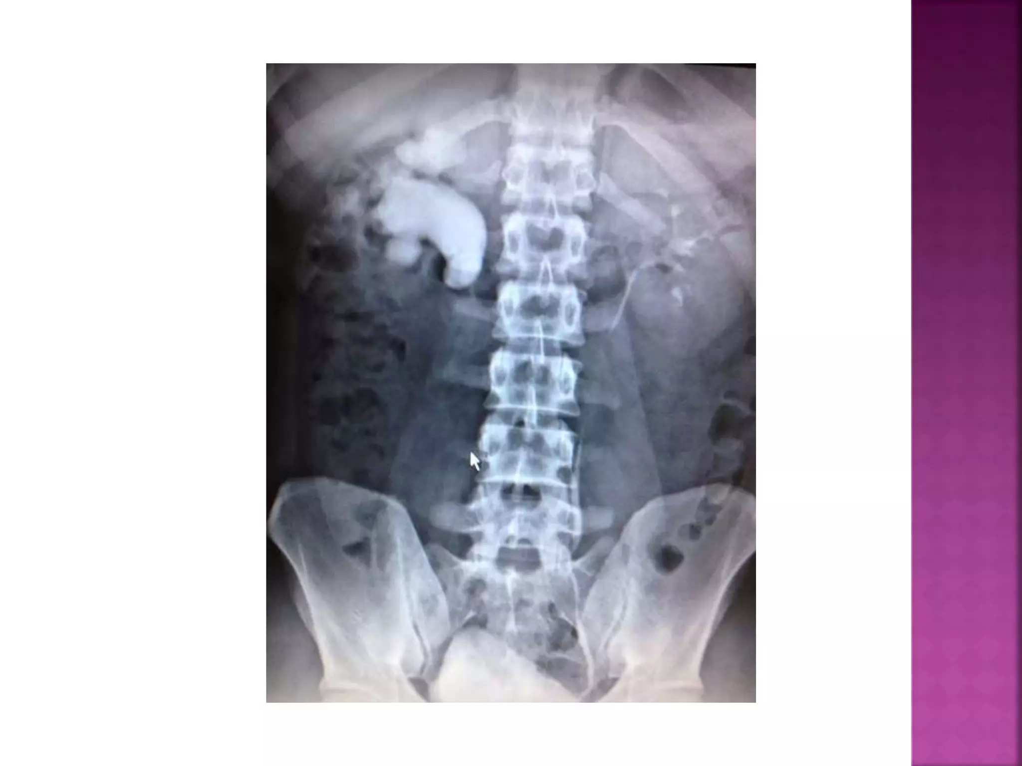 Signs in radiology | PPT