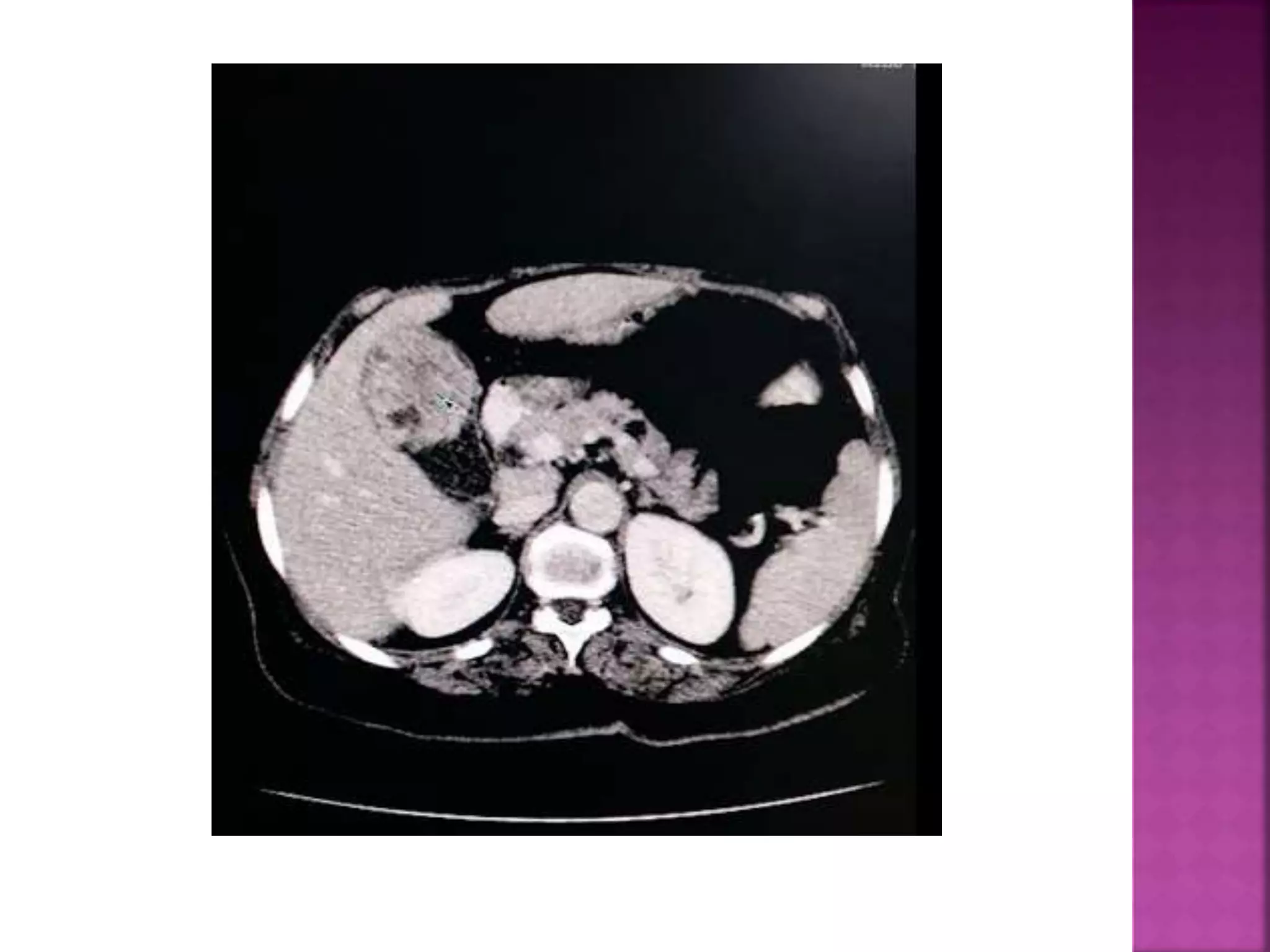 Signs in radiology | PPT