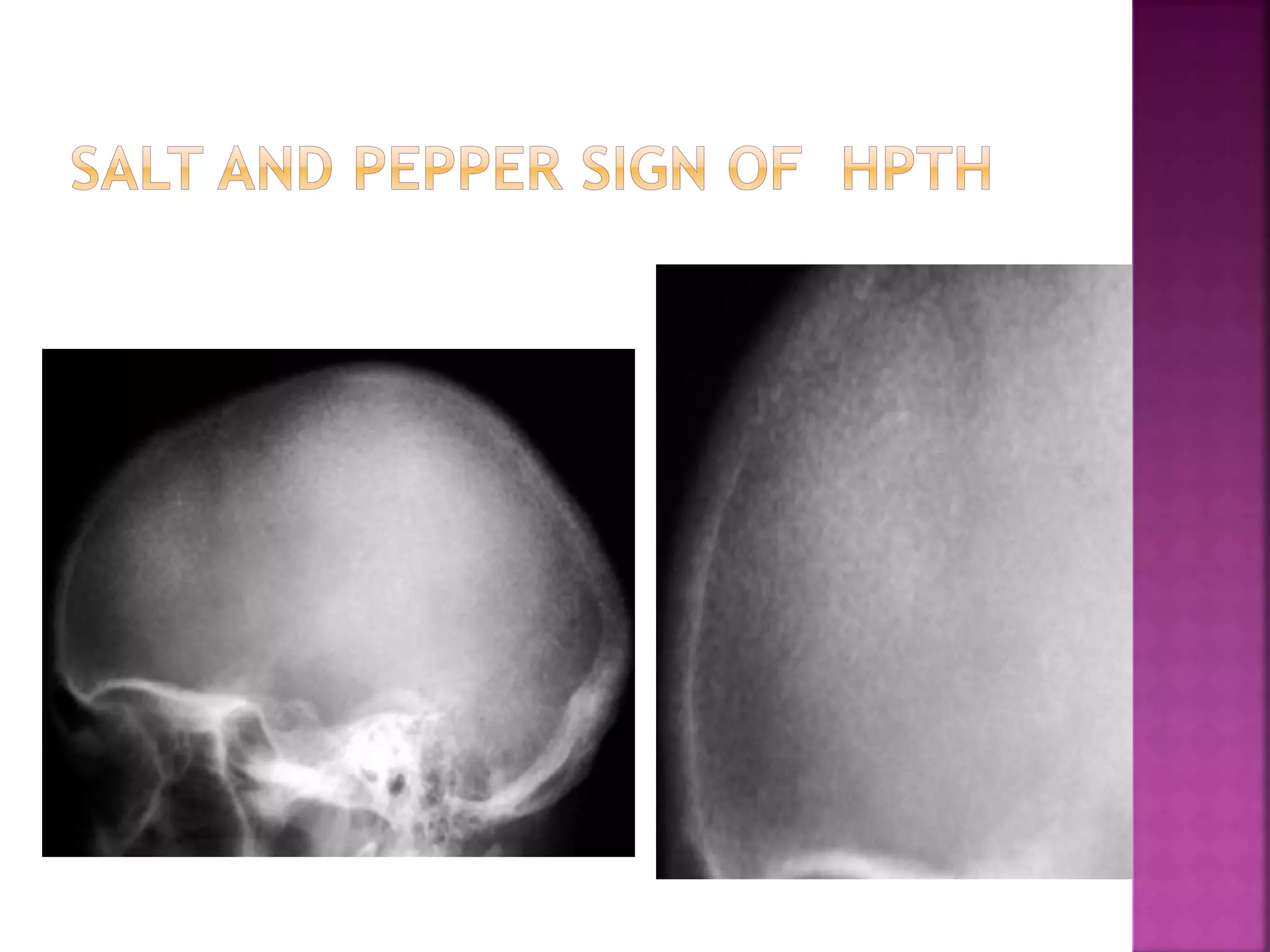 Signs in radiology | PPT