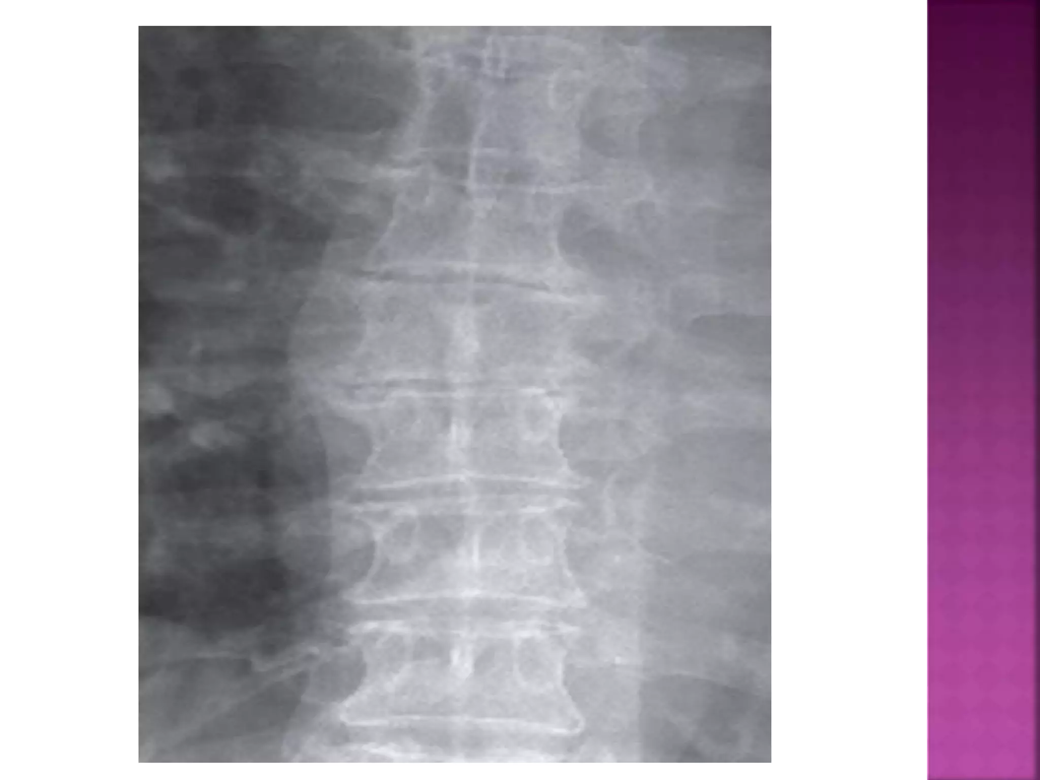 Signs in radiology | PPT