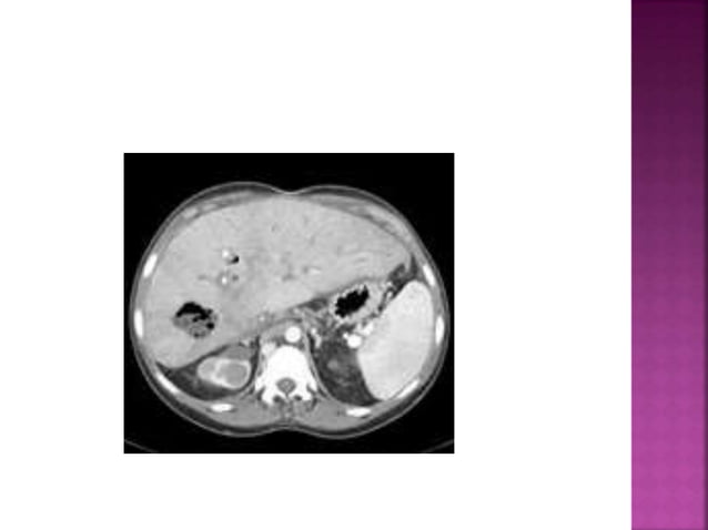 Signs in radiology | PPT