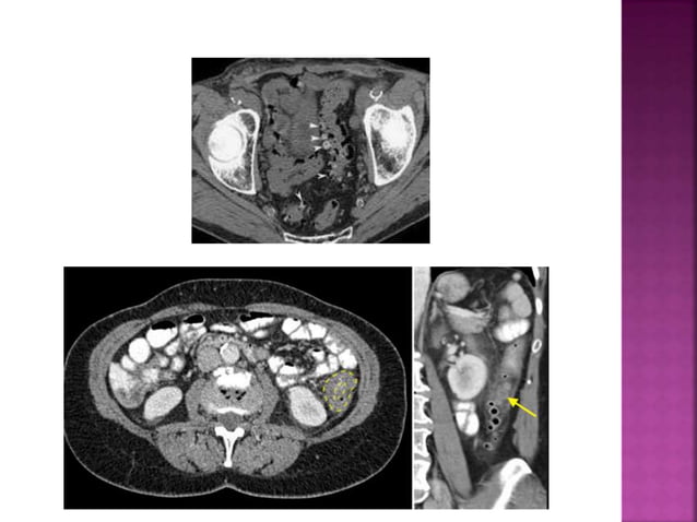 Signs in radiology | PPT