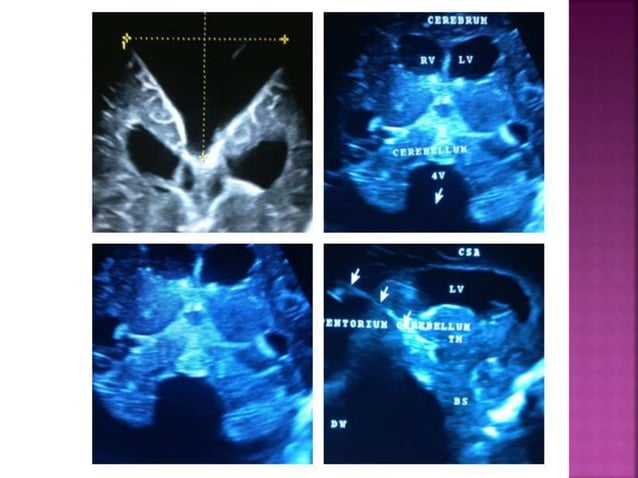 Signs in radiology | PPT