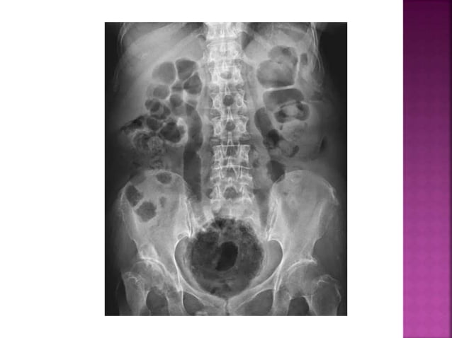 Signs in radiology | PPT