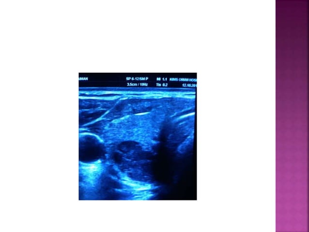 Signs in radiology | PPT