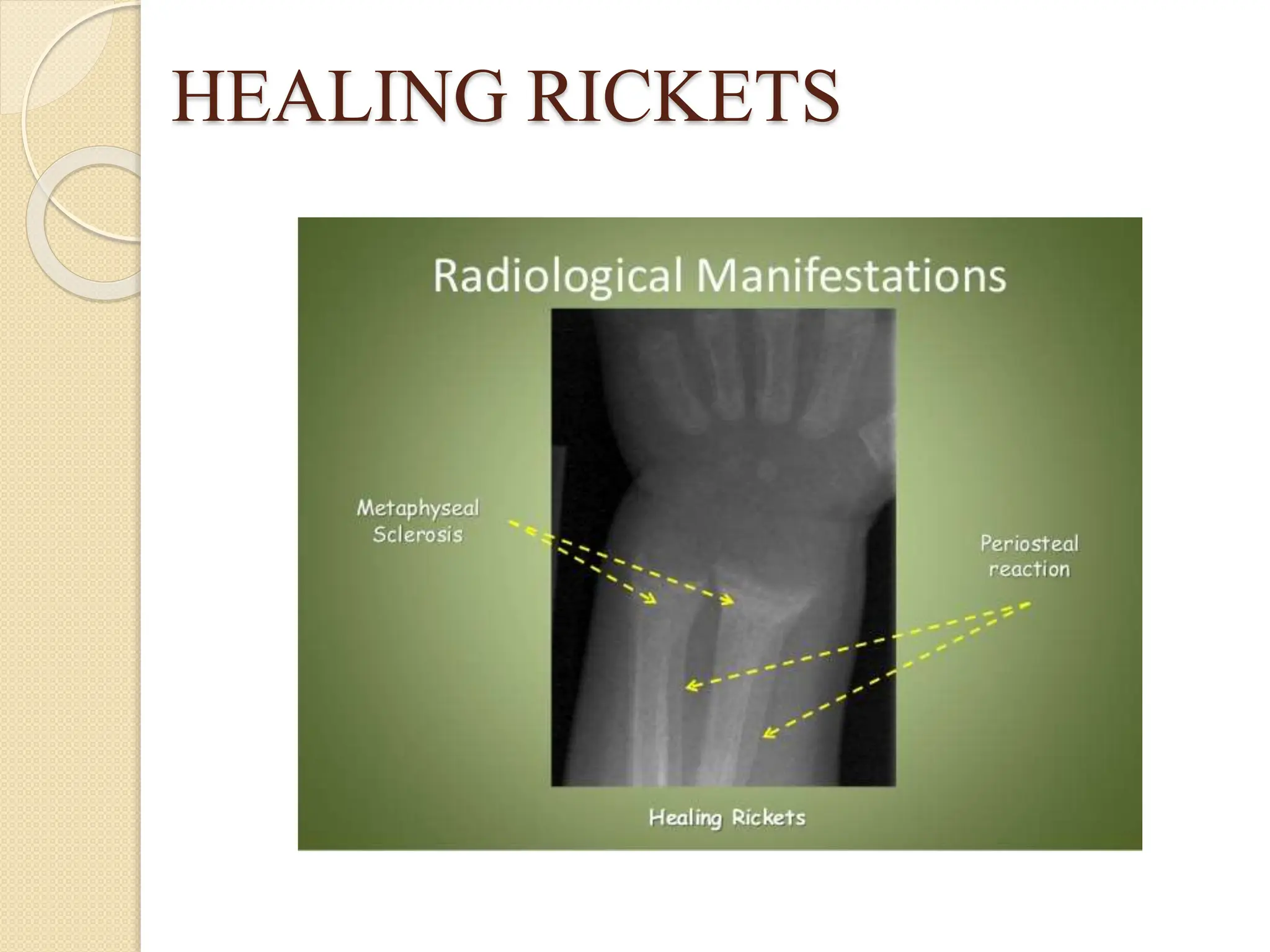 Rickets: a bone softening disease radiologic signs | PPTX