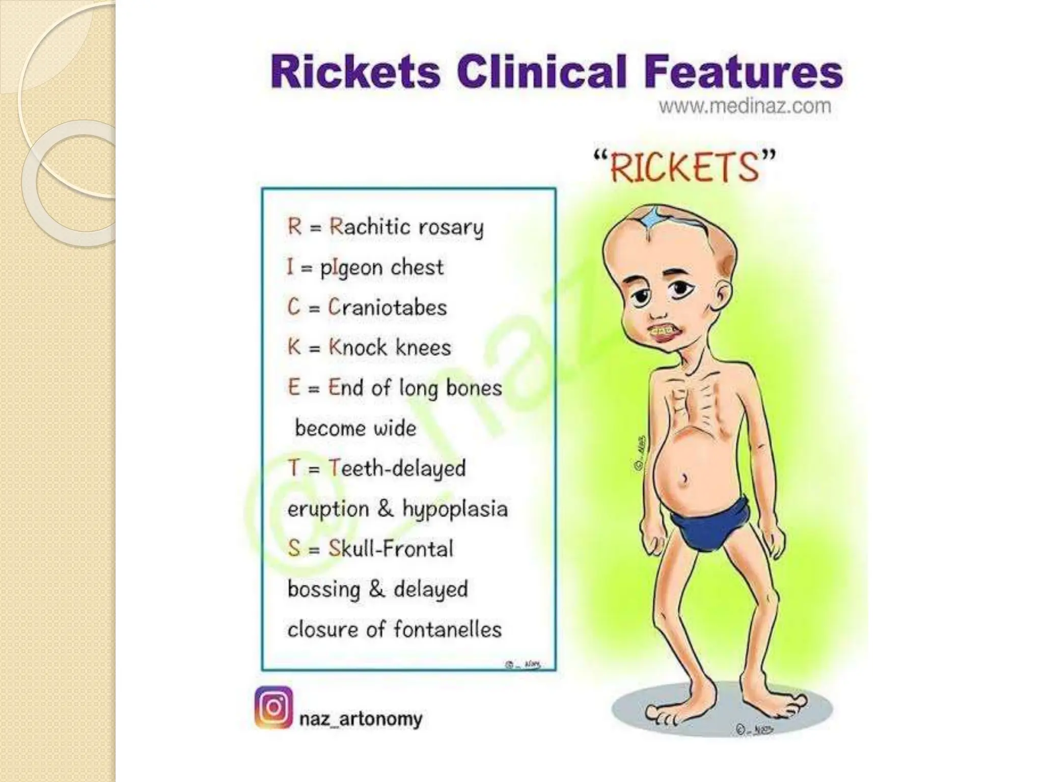 Rickets: a bone softening disease radiologic signs | PPTX | Thyroid ...