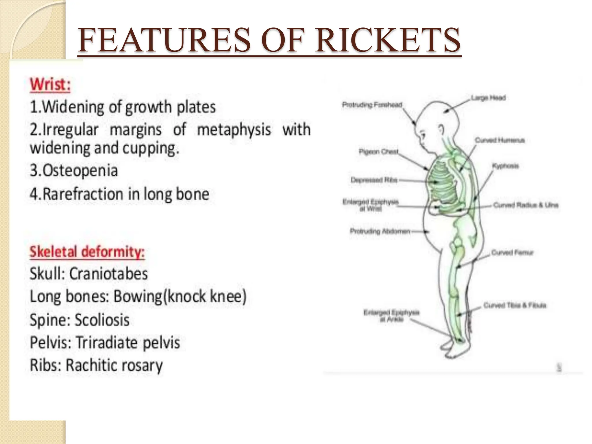 Rickets: a bone softening disease radiologic signs | PPTX | Thyroid ...